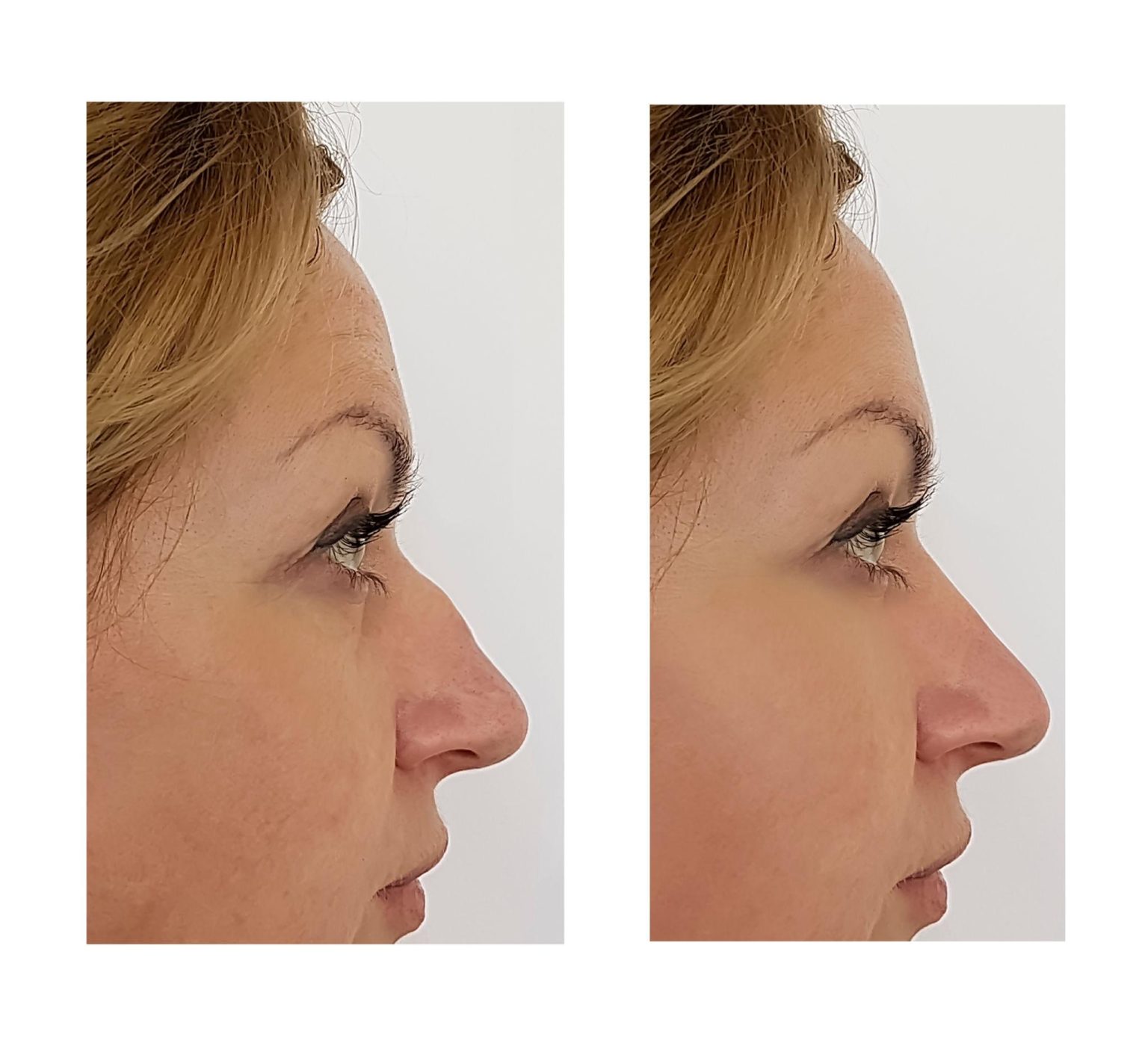 Non Surgical Nose Reshaping Dubai | Liquid Rhinoplasty